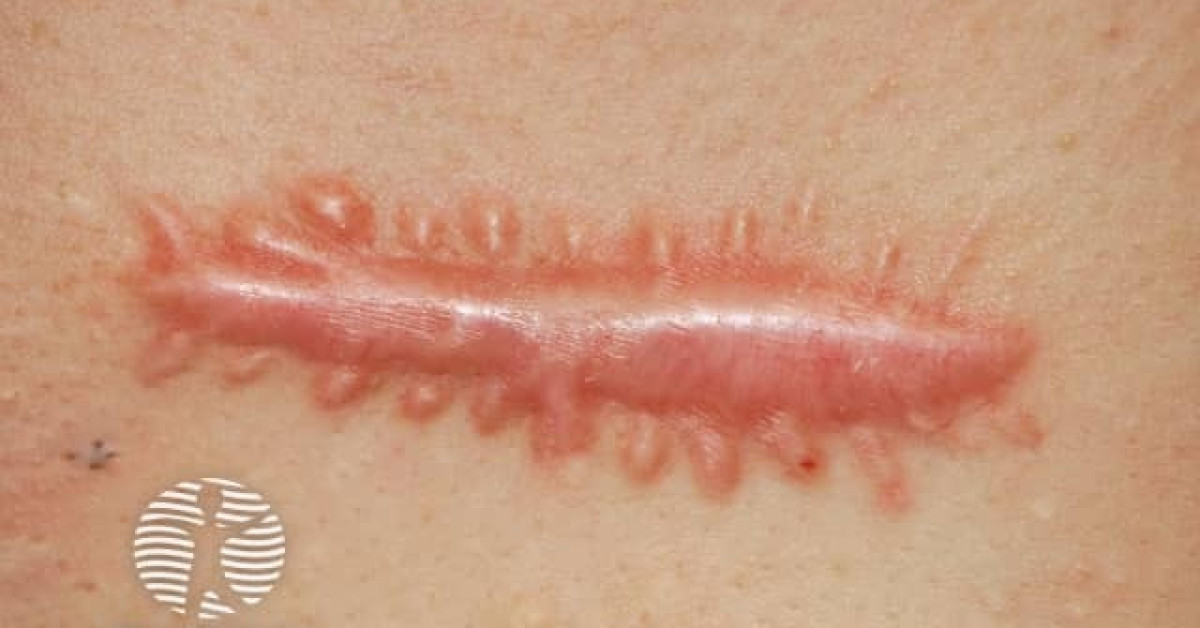 Hypertrophic surgical scar image