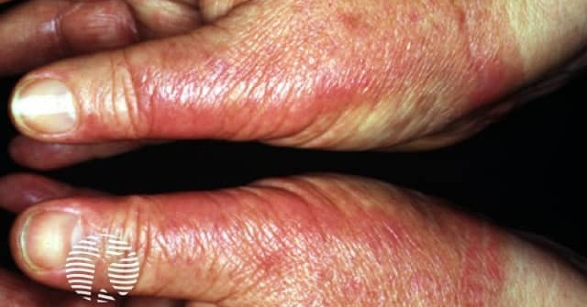 Hands burning after PUVA soaks image