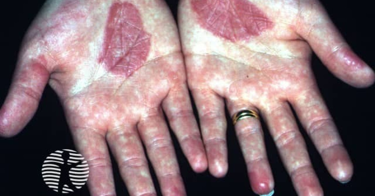 Hands burning after PUVA soaks image