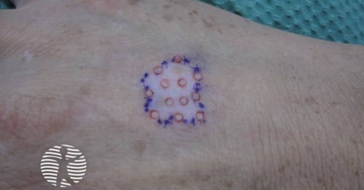 Punch grafting in vitiligo image