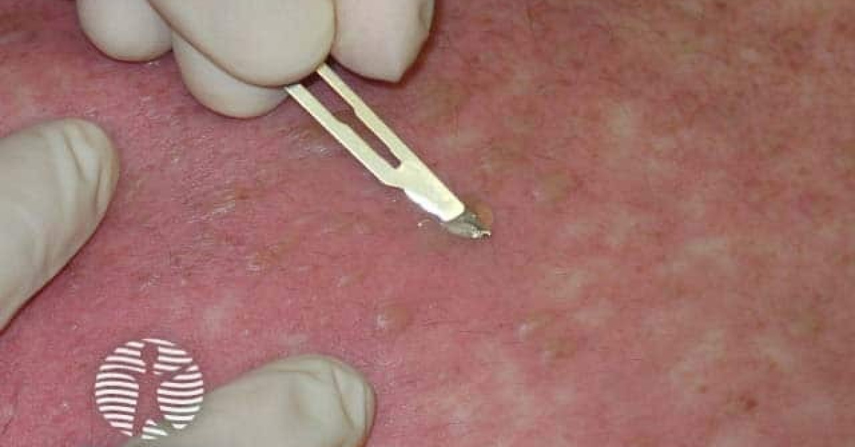 Preparing a Tzanck smear image