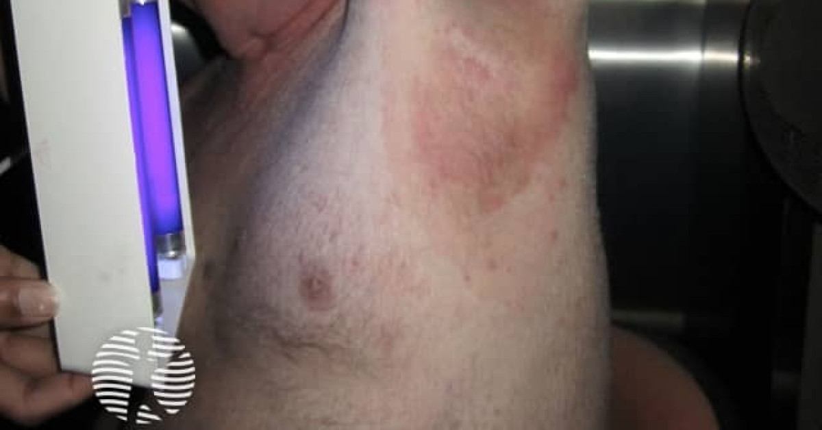 Wood lamp examimation image