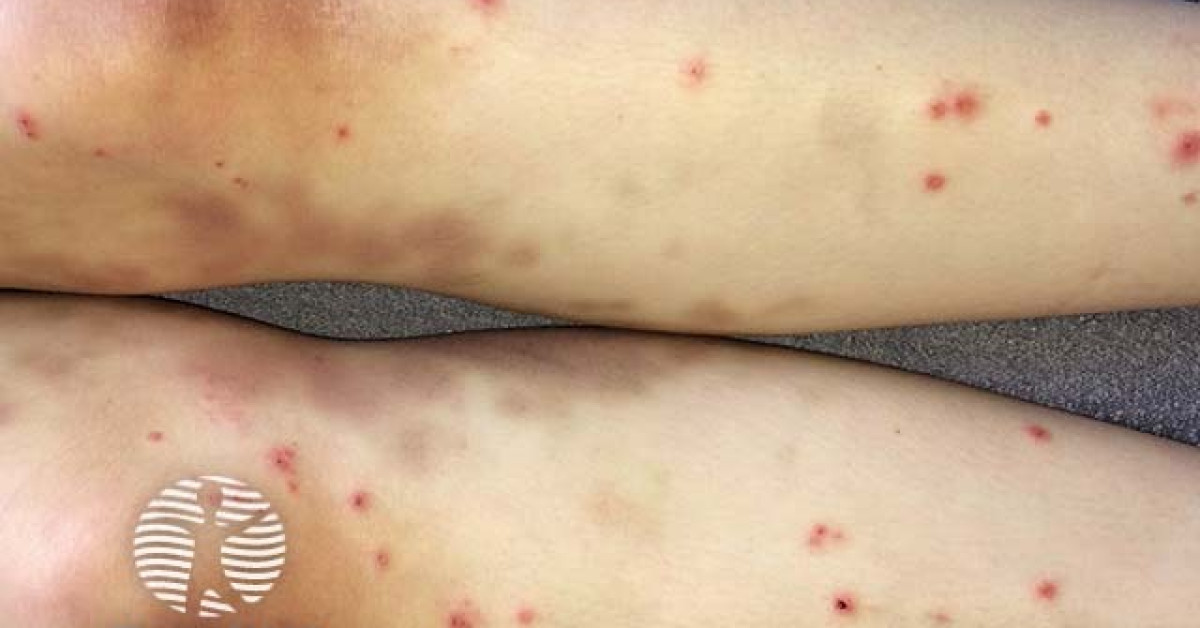 Excoriations and bruises due to pruritus / cholestasis image