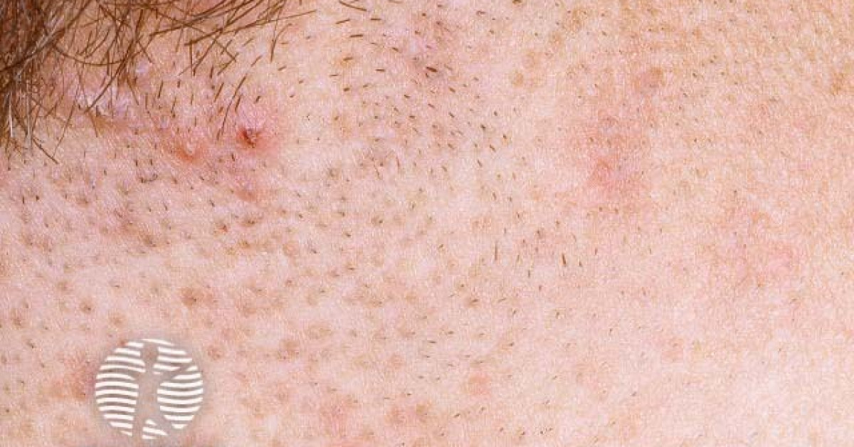 Pseudofolliculitis barbae image