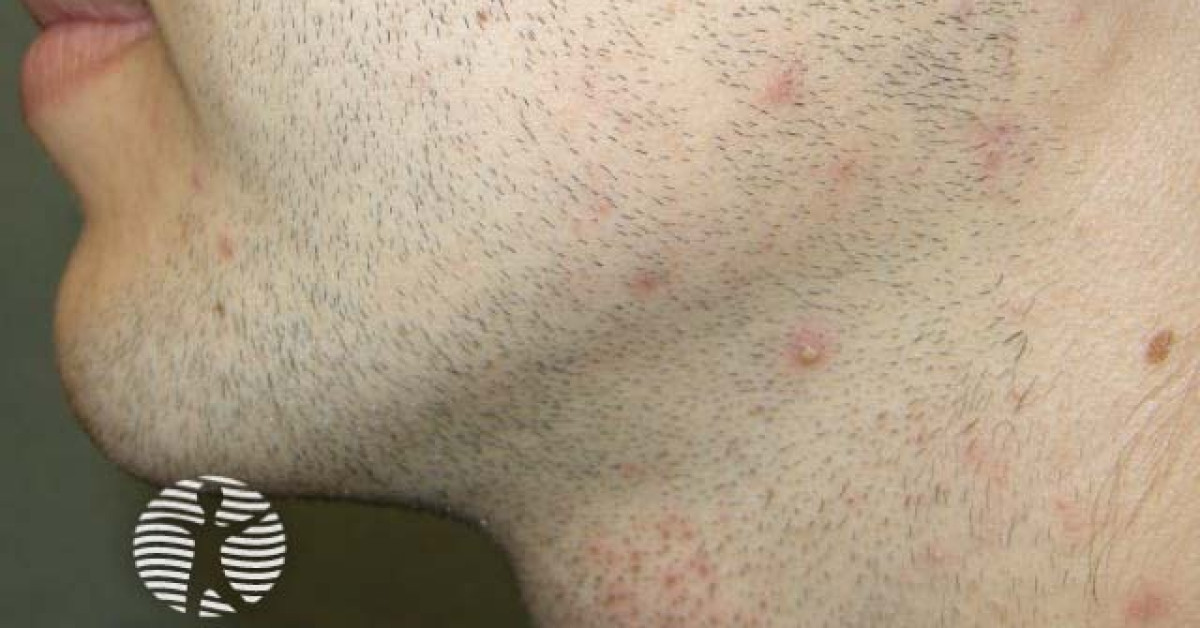 Pseudofolliculitis barbae image