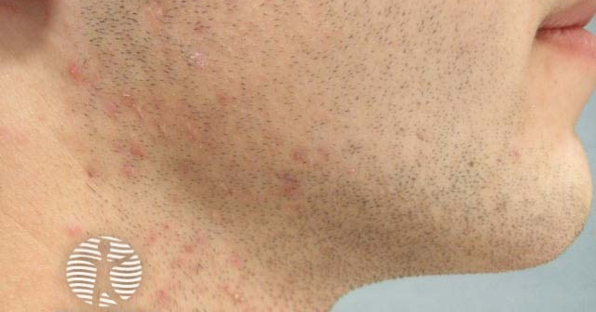 Pseudofolliculitis barbae image