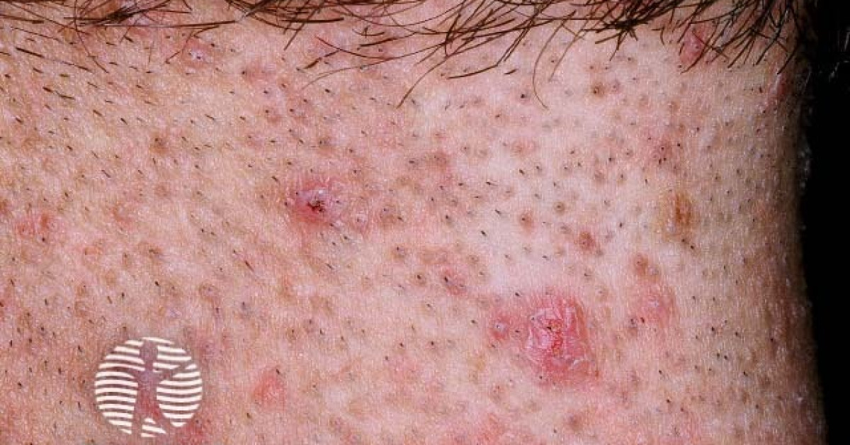 Pseudofolliculitis barbae image