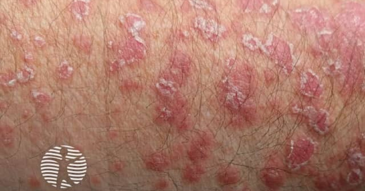 Small plaque psoriasis image