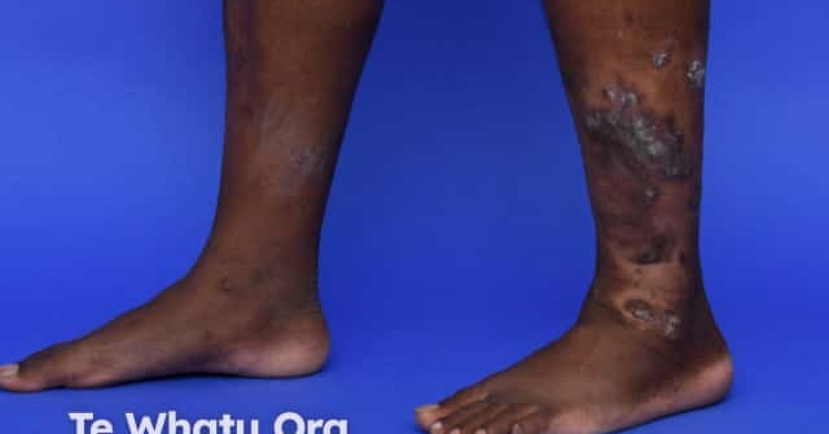 Psoriasis in dark skin image
