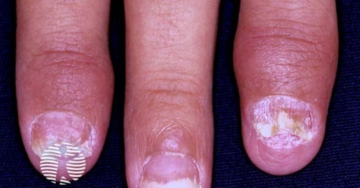 Nail psoriasis image