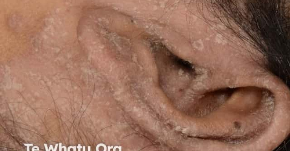 Facial psoriasis image