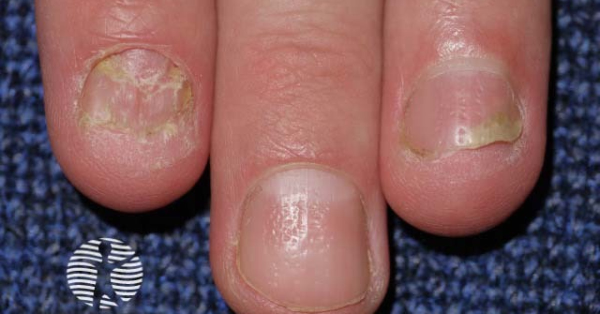 Psoriatic nail dystrophy image