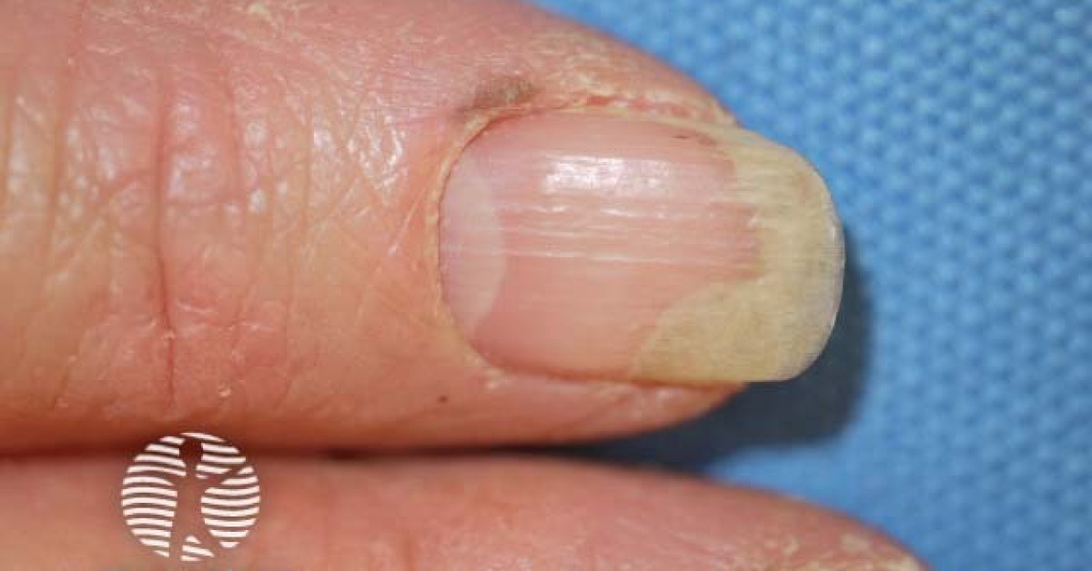 DermNet® - Psoriatic nail dystrophy image