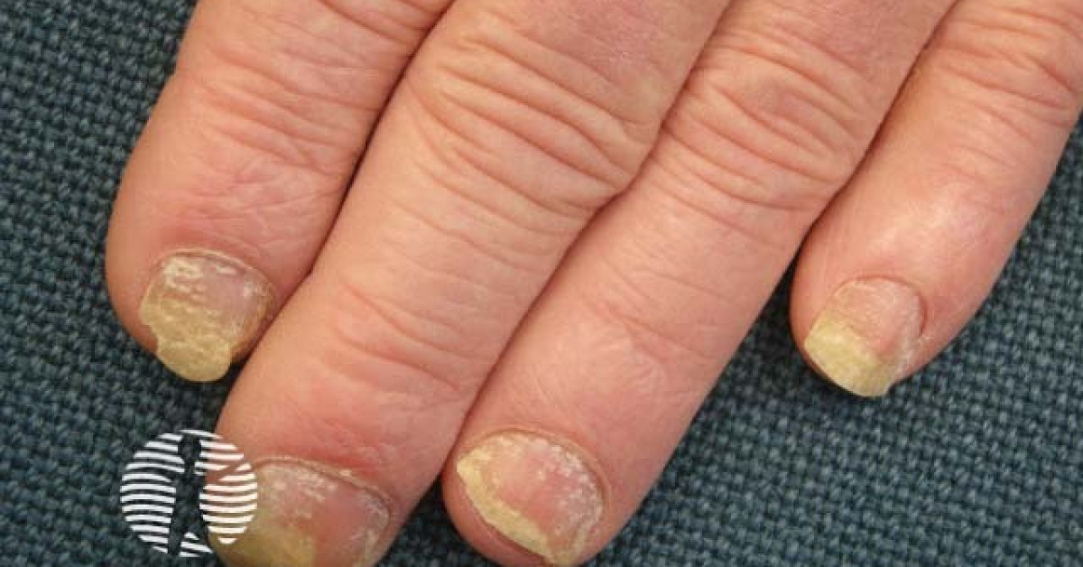 Psoriatic nail dystrophy image