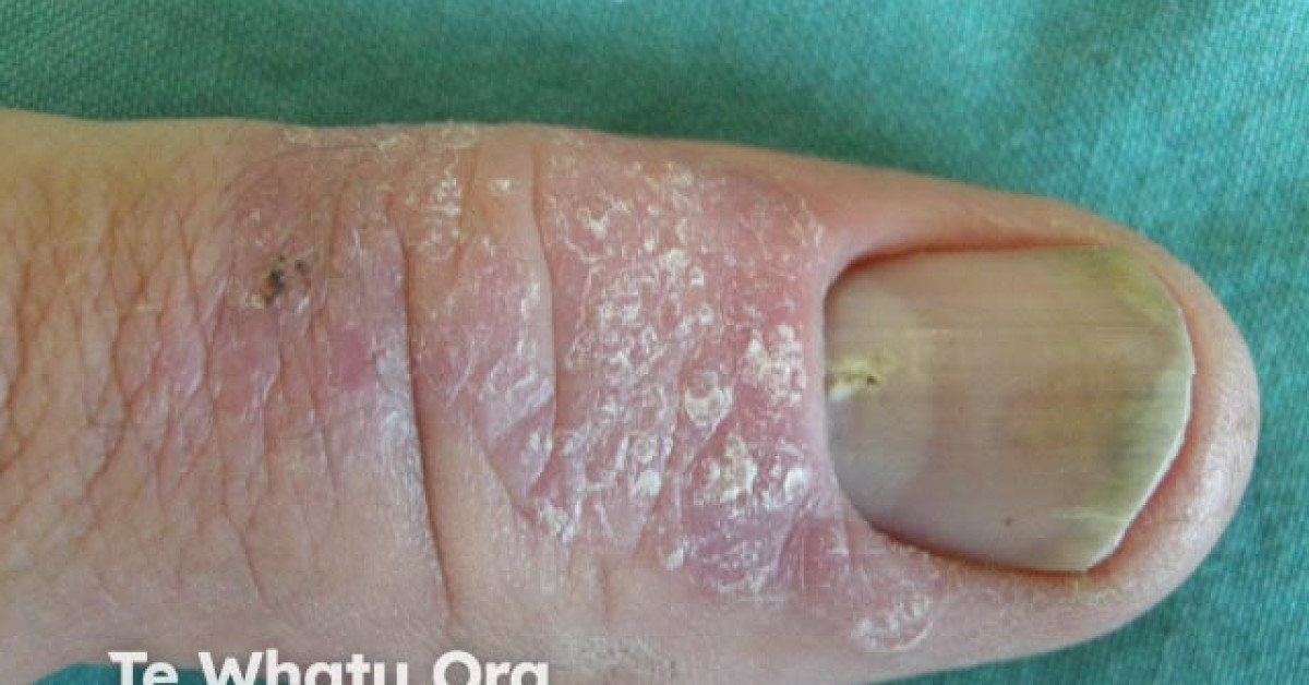 Psoriatic nail dystrophy image