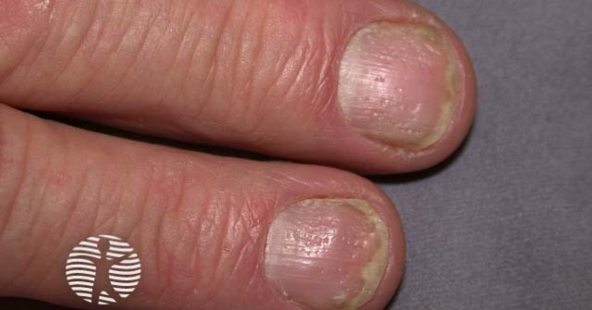 Psoriatic nail dystrophy image