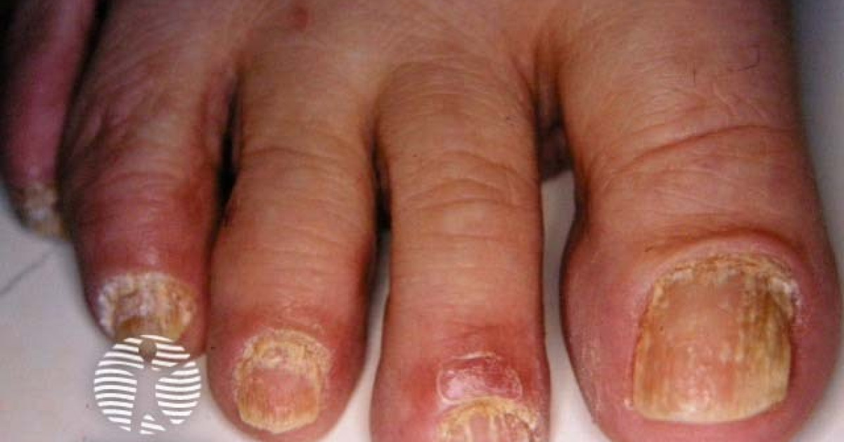 DermNet® - Psoriatic nail dystrophy image