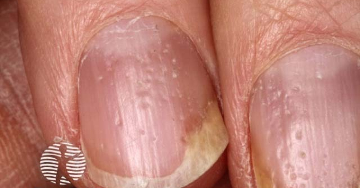 Psoriatic nail dystrophy image