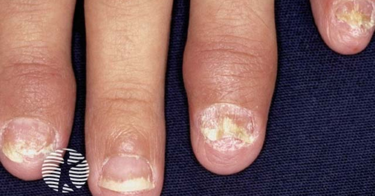 Psoriatic nail dystrophy image