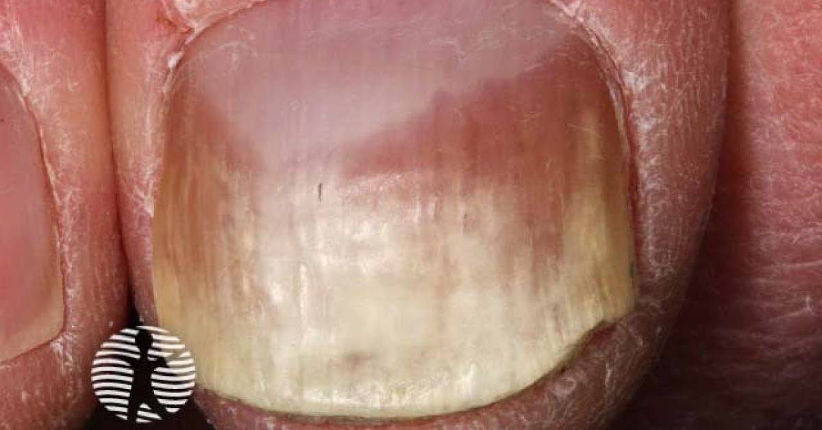 Psoriatic nail dystrophy image