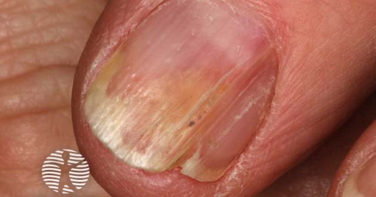 Psoriatic nail dystrophy image
