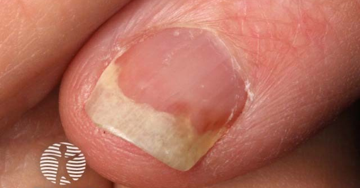 Psoriatic nail dystrophy image
