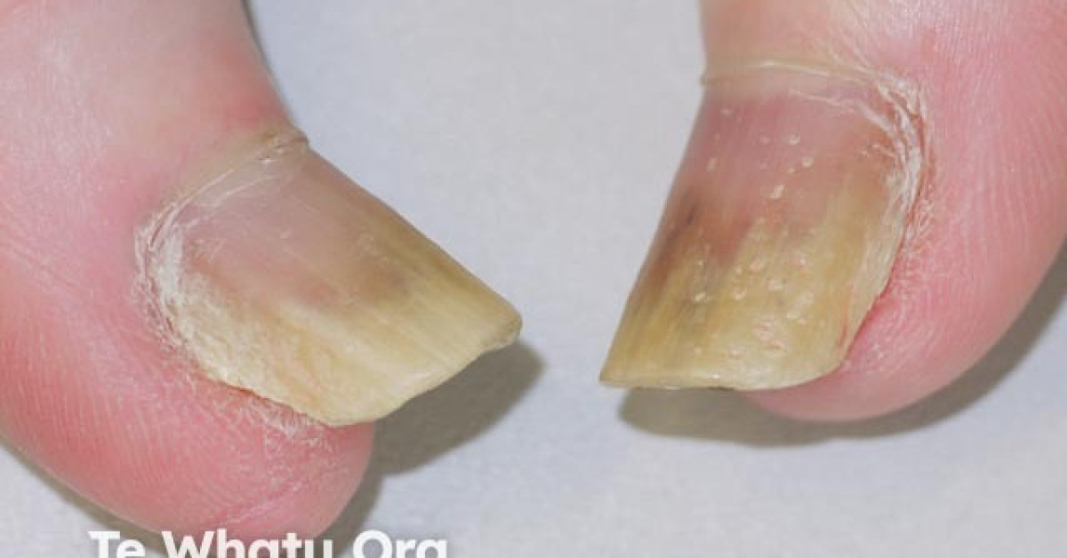 Psoriatic nail dystrophy image