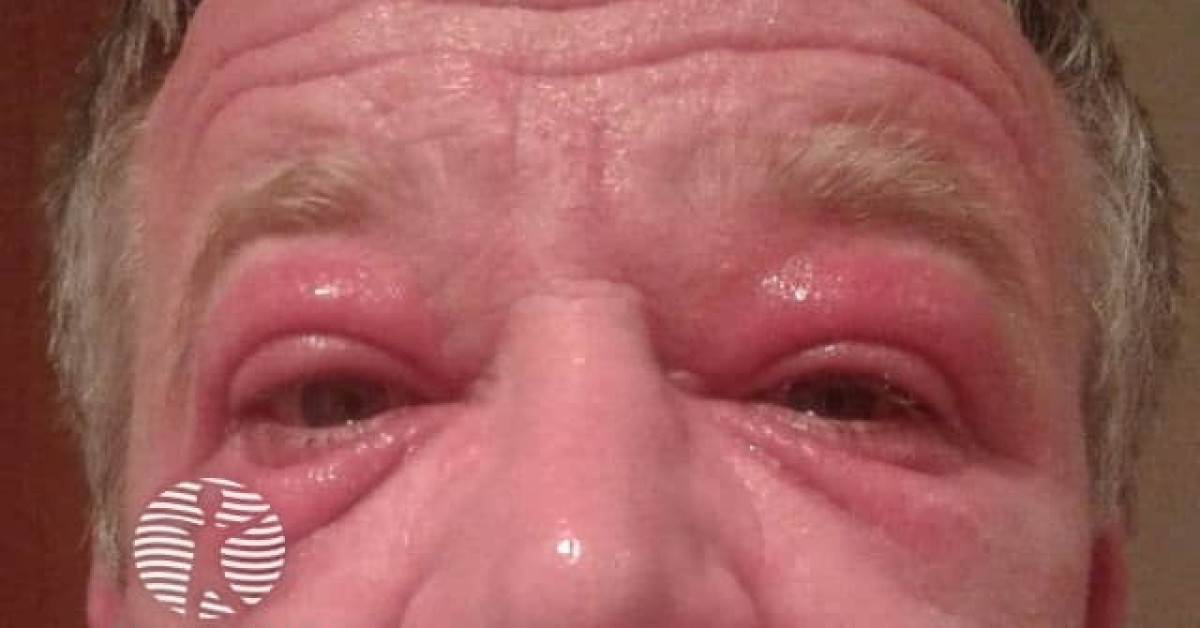 Contact allergy to para-tertiary butylphenol formaldehyde resin image