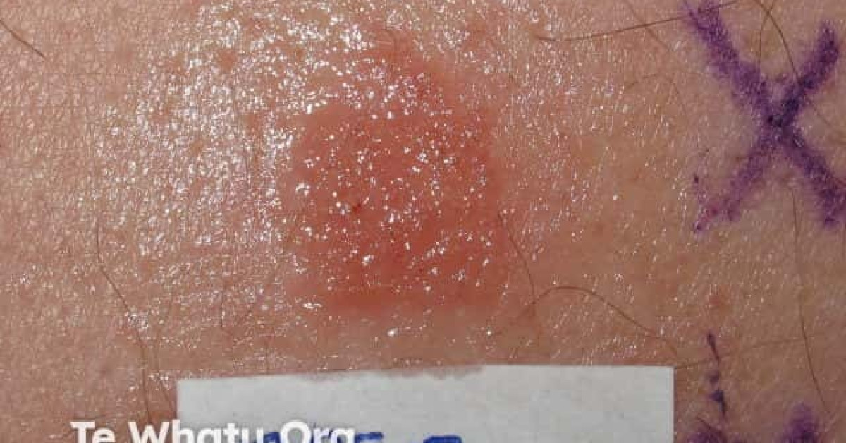 Positive patch test to paratertiary butylphenol formaldehyde resin image