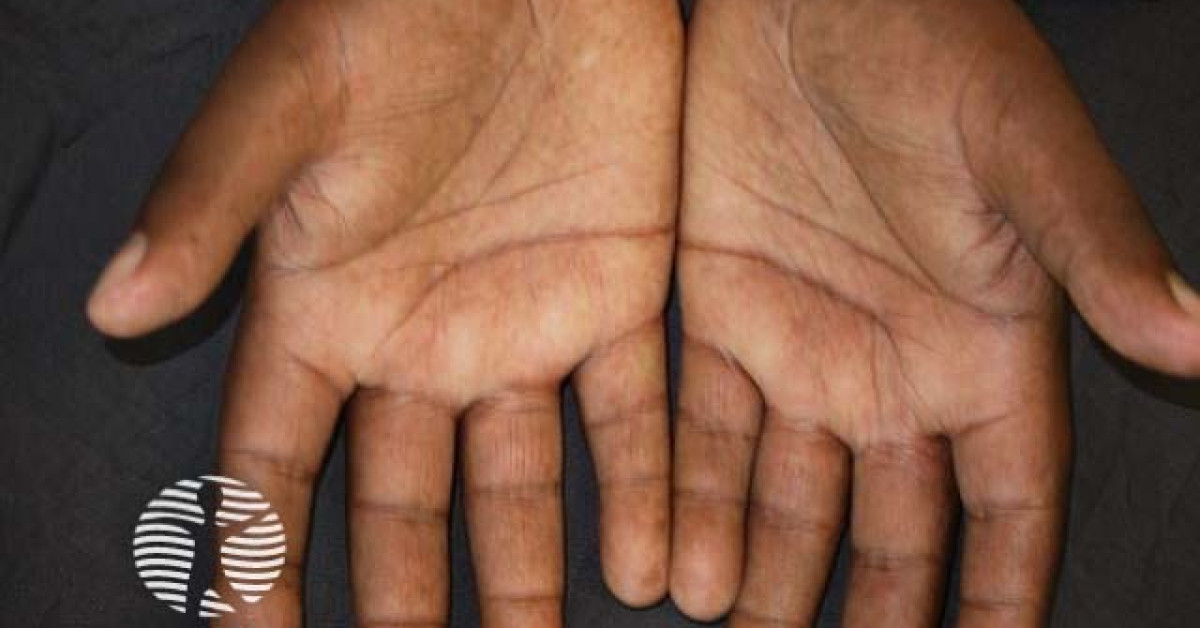 Puffy hand in early systemic sclerosis image