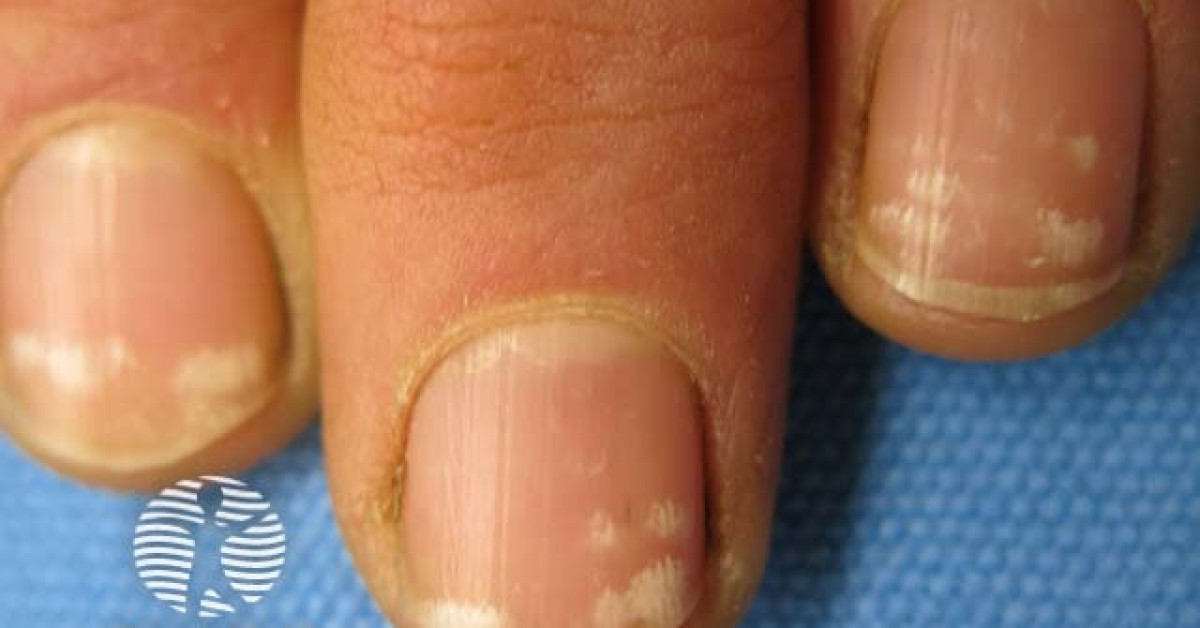 Punctate leukonychia image