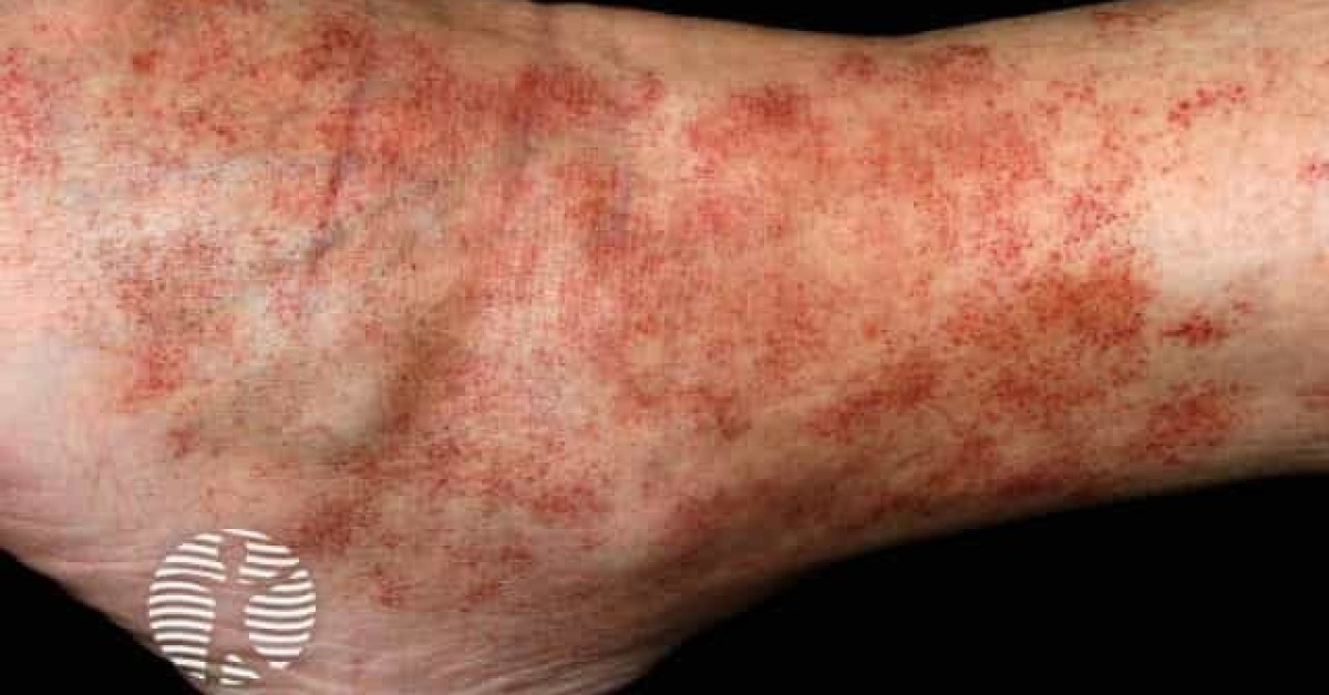 Pigmented purpuric dermatitis image
