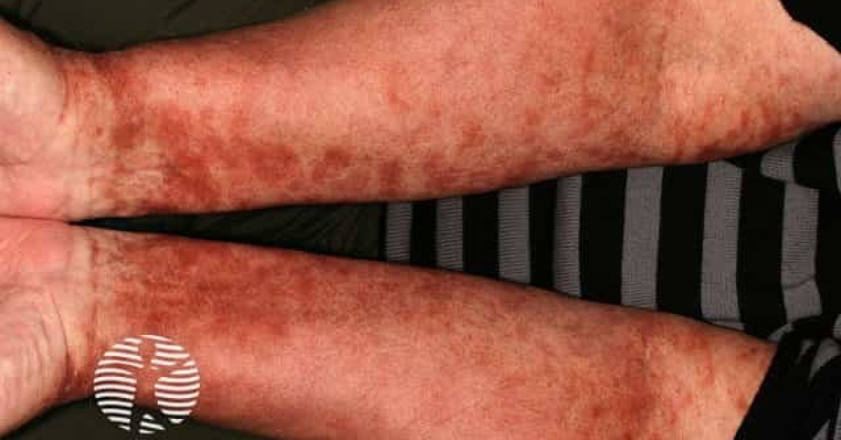 Pigmented purpuric dermatitis image