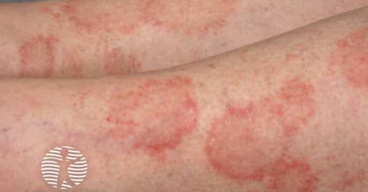 Pigmented purpuric dermatitis image