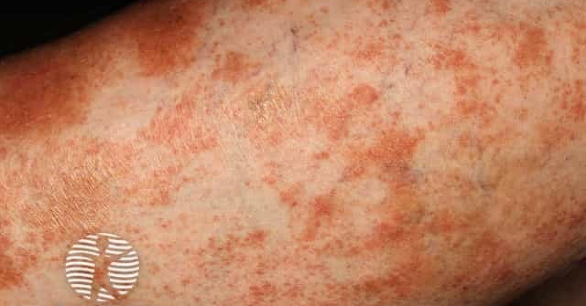 Pigmented purpuric dermatitis image