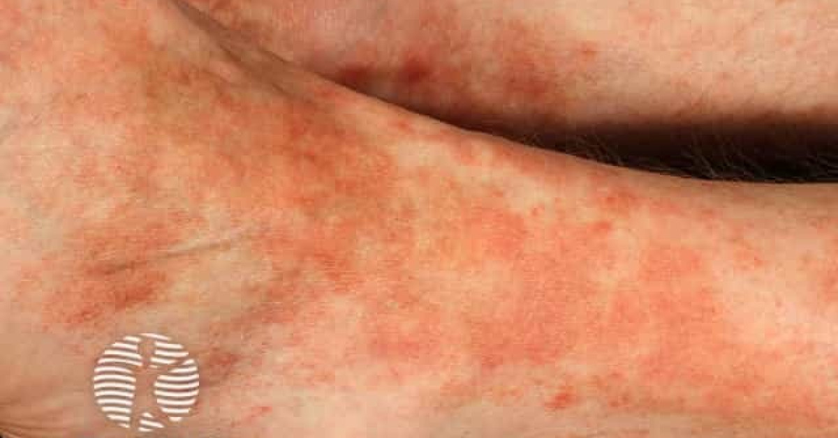 Pigmented purpuric dermatitis image