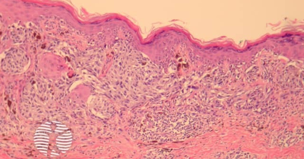 Radial growth phase superficial spreading melanoma image