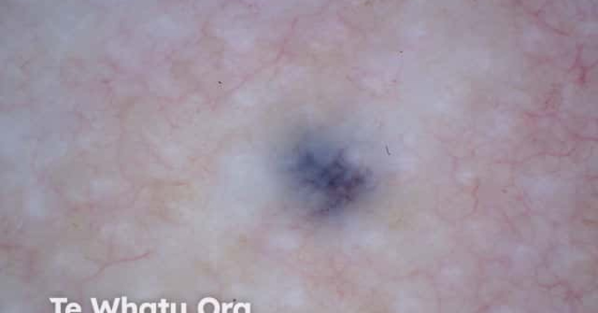 Radiation tattoo dermoscopy image