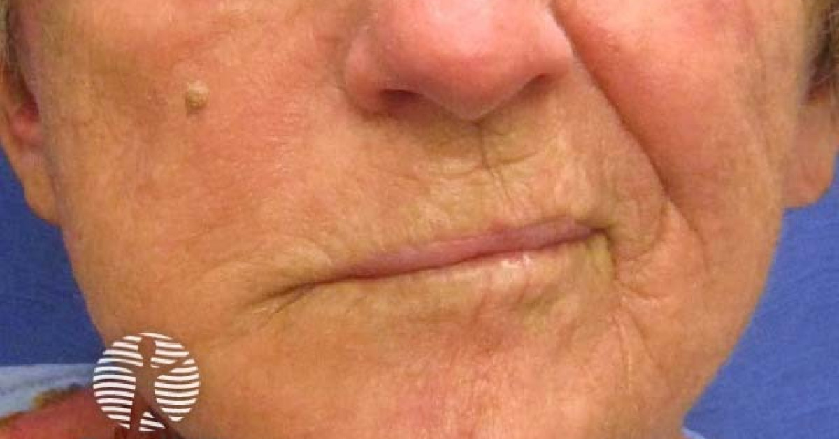 Ramsay Hunt Syndrome Facial Palsy Image