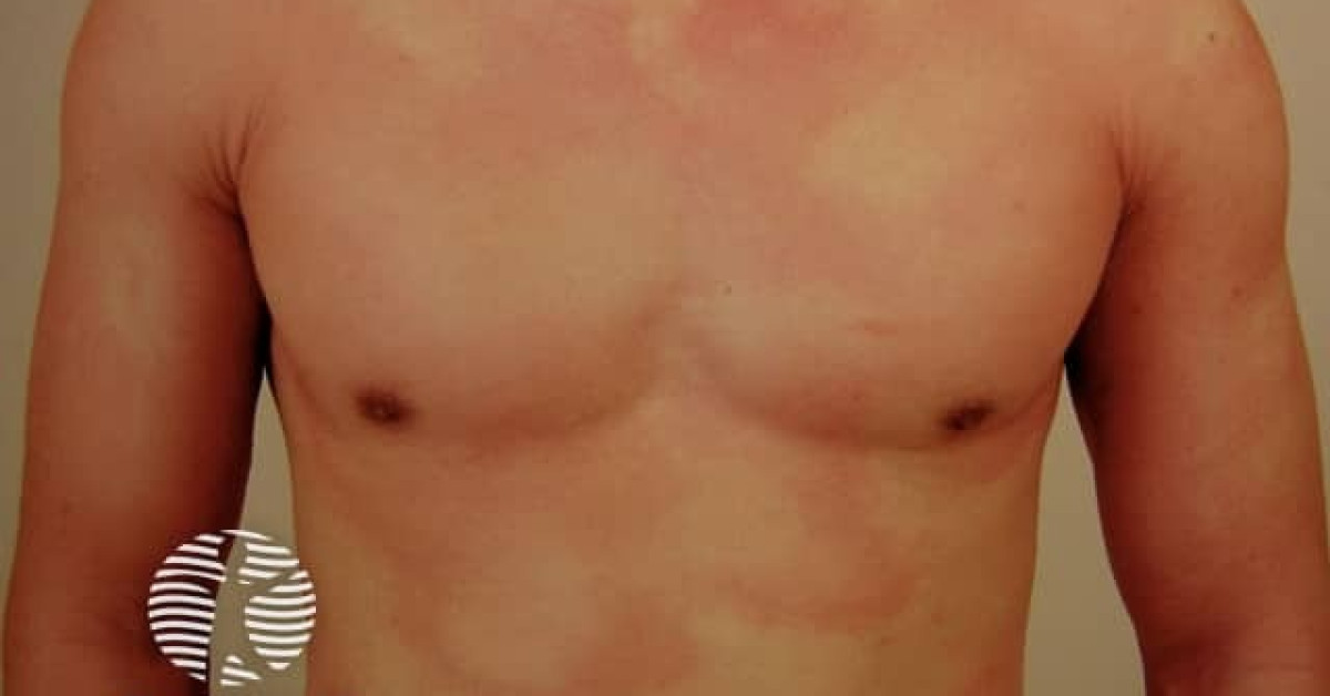 Acute urticaria image