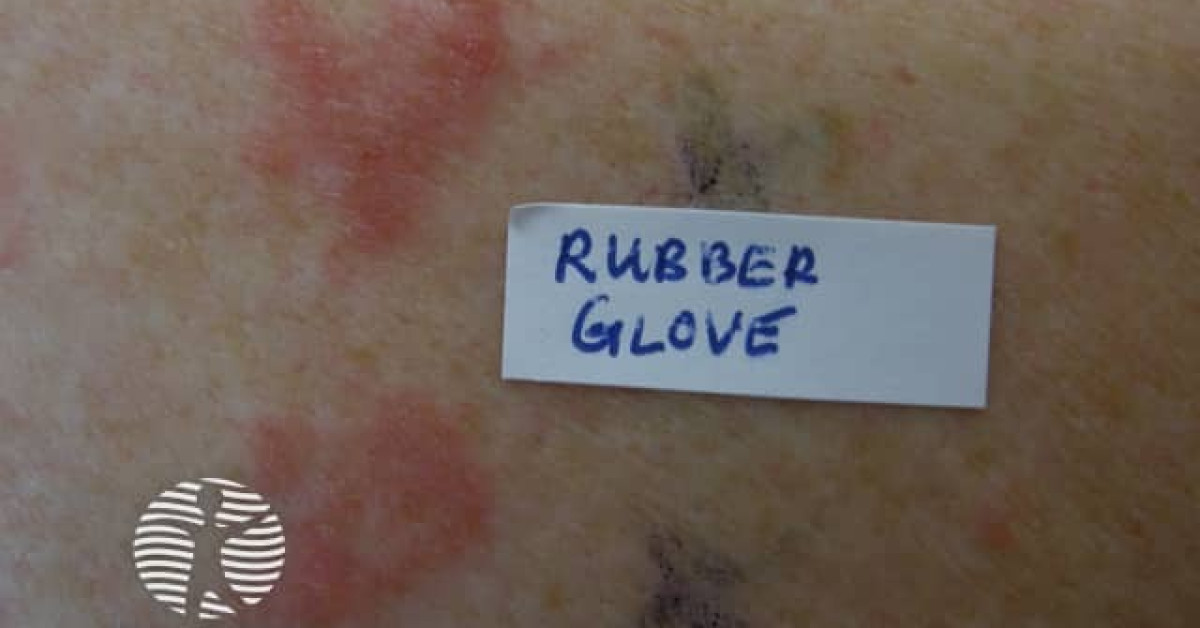 Allergic contact dermatitis to rubber image