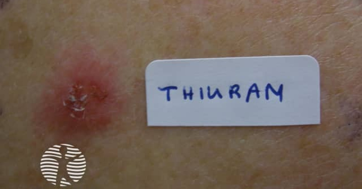 Allergic contact dermatitis to rubber image