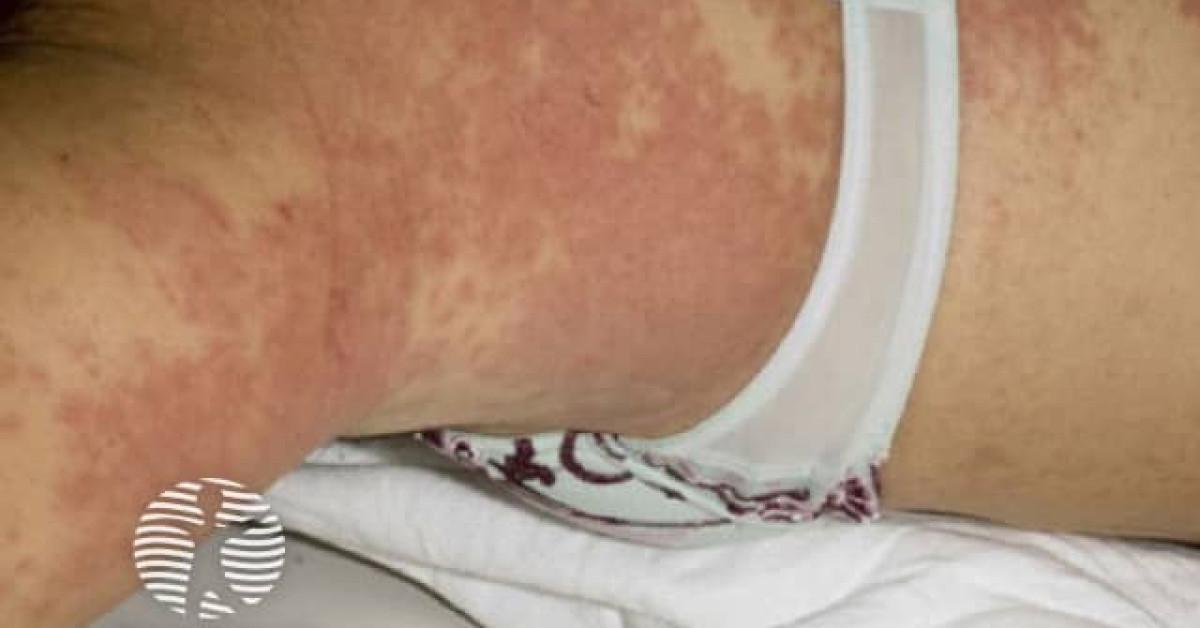 Acute generalised exanthematous pustulosis (AGEP) image