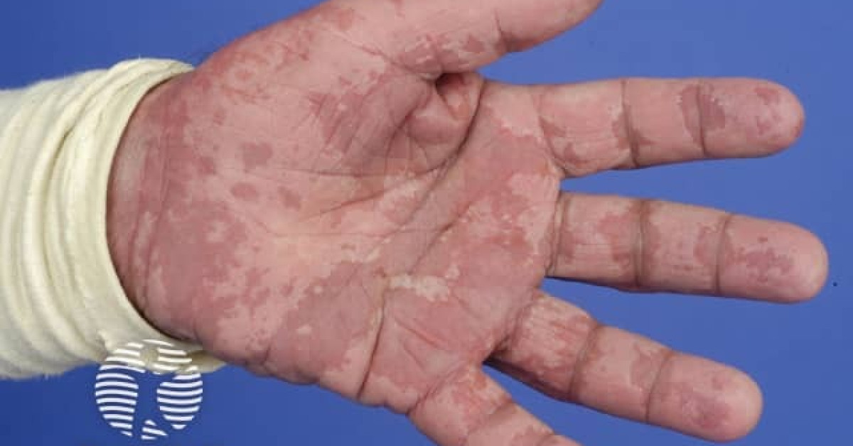 Acute generalised exanthematous pustulosis (AGEP) image