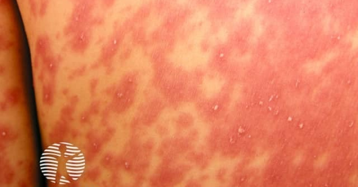 Acute generalised exanthematous pustulosis (AGEP) image