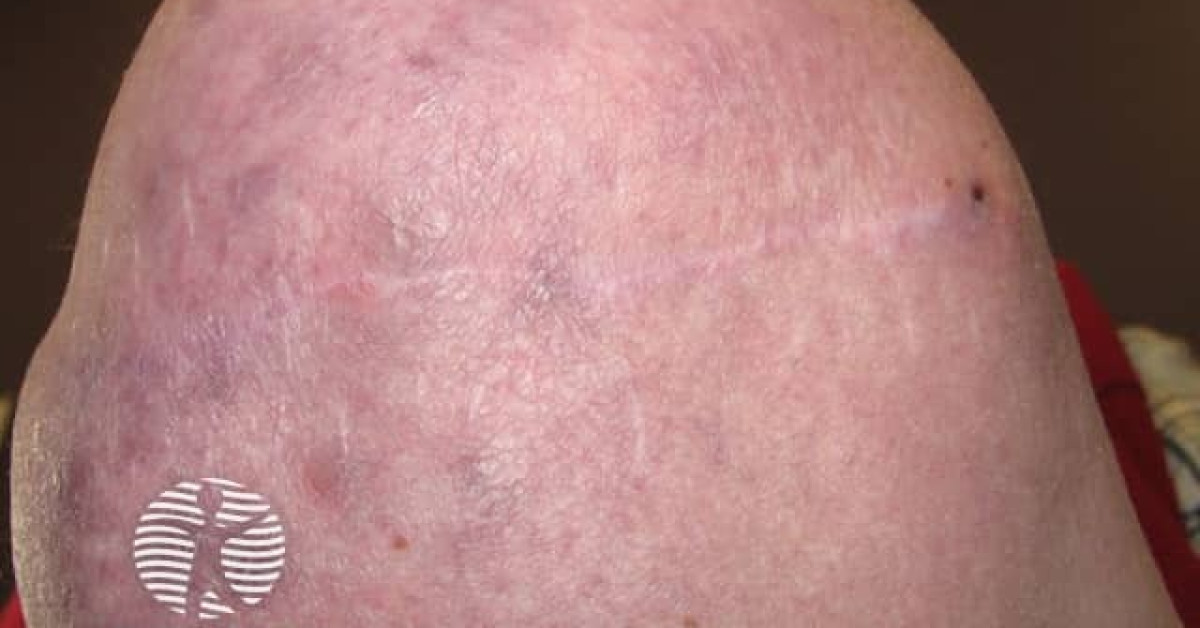 Skin problems affecting an amputation stump image