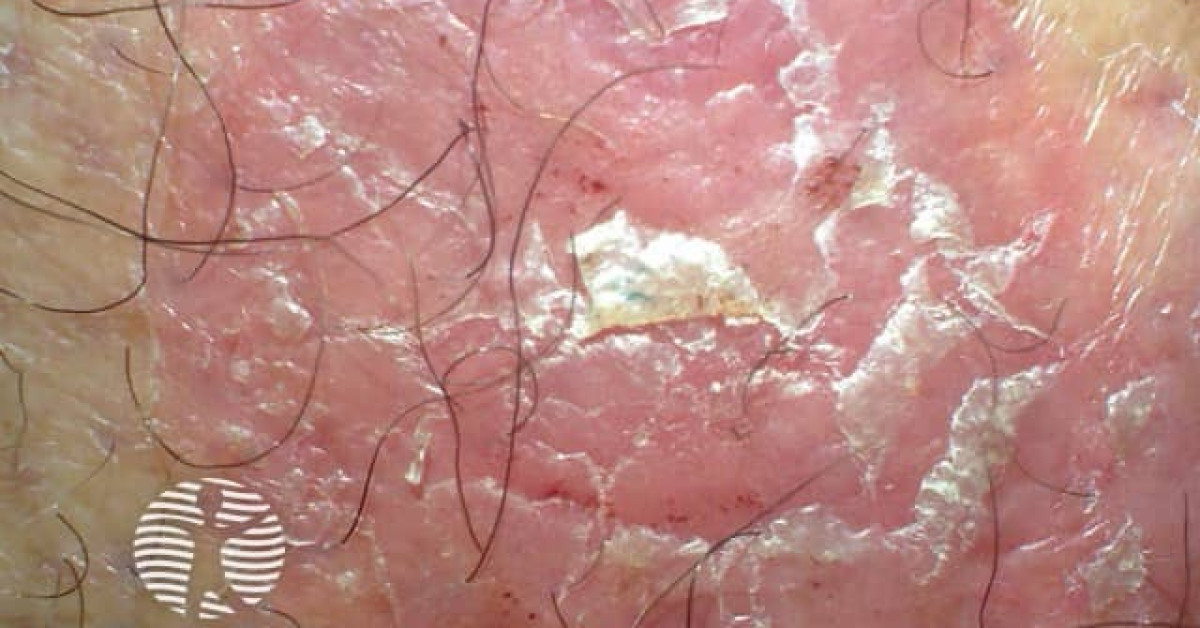 Skin problems affecting an amputation stump image