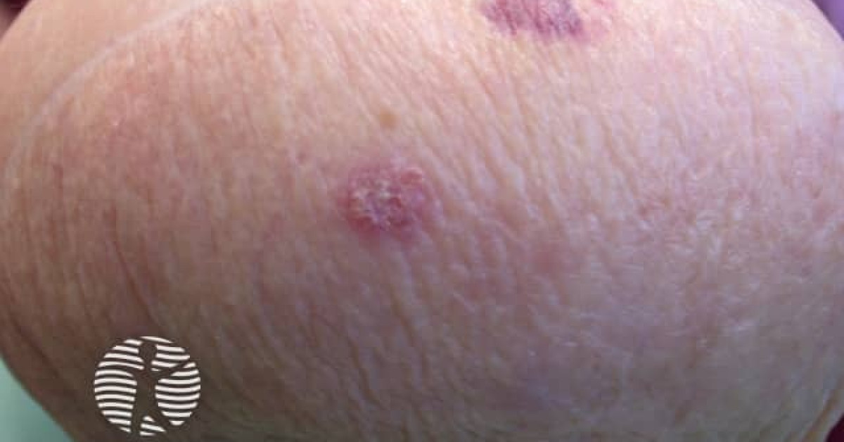 Skin cancer arising on limb of amputee image