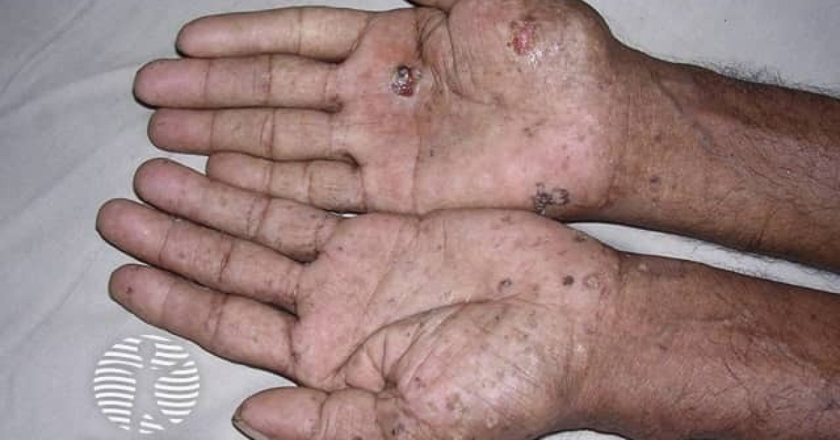 Arsenical keratoses image