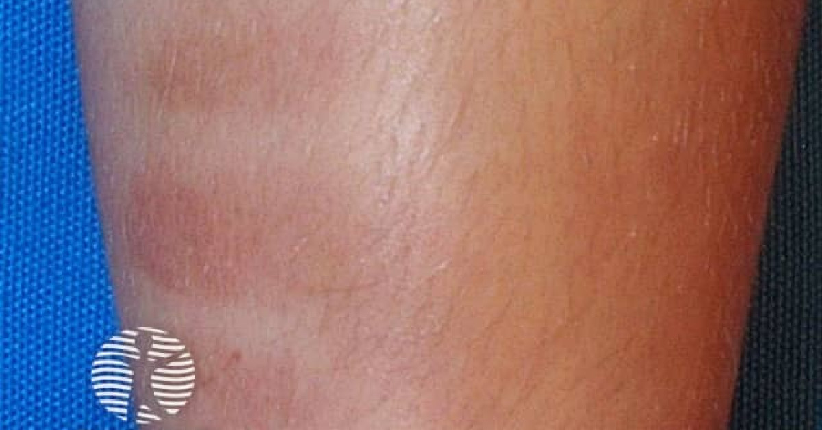Photocontact dermatitis image